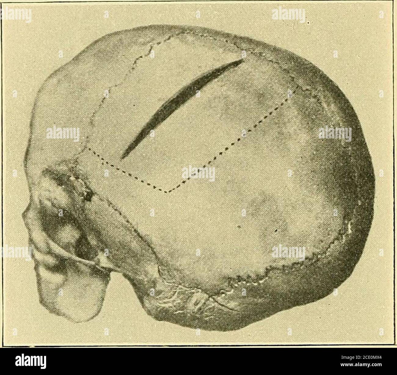 Half skull with brain hi-res stock photography and images - Alamy