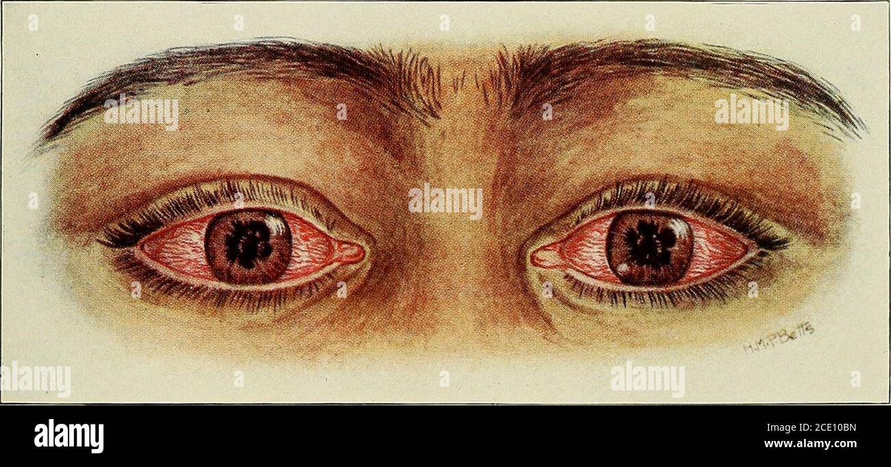 Syphilis In The Eye
