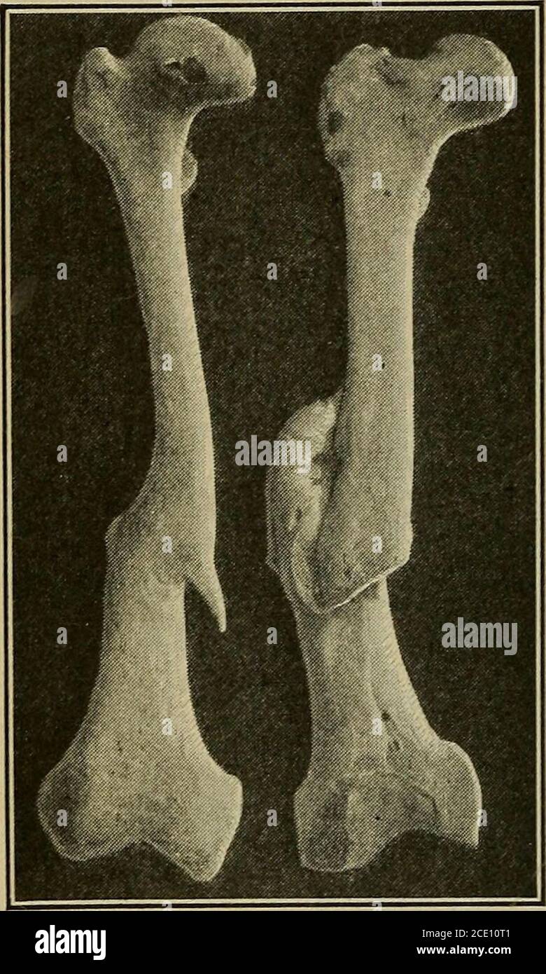 Setting a broken bone hi-res stock photography and images - Alamy