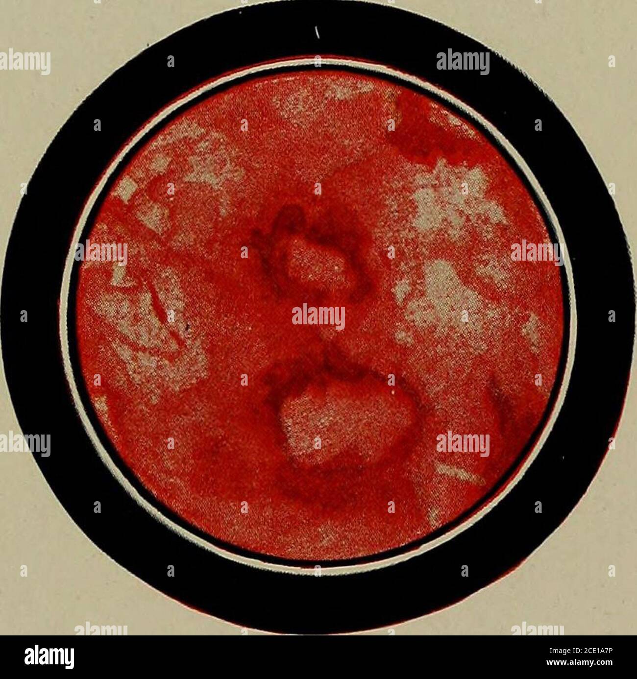 Tertiary syphilis hi-res stock photography and images - Alamy