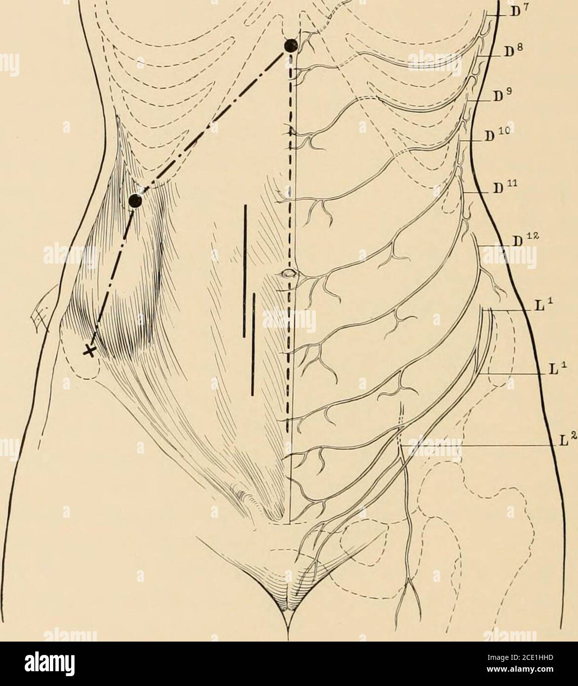 Mcburney incision hi-res stock photography and images - Alamy