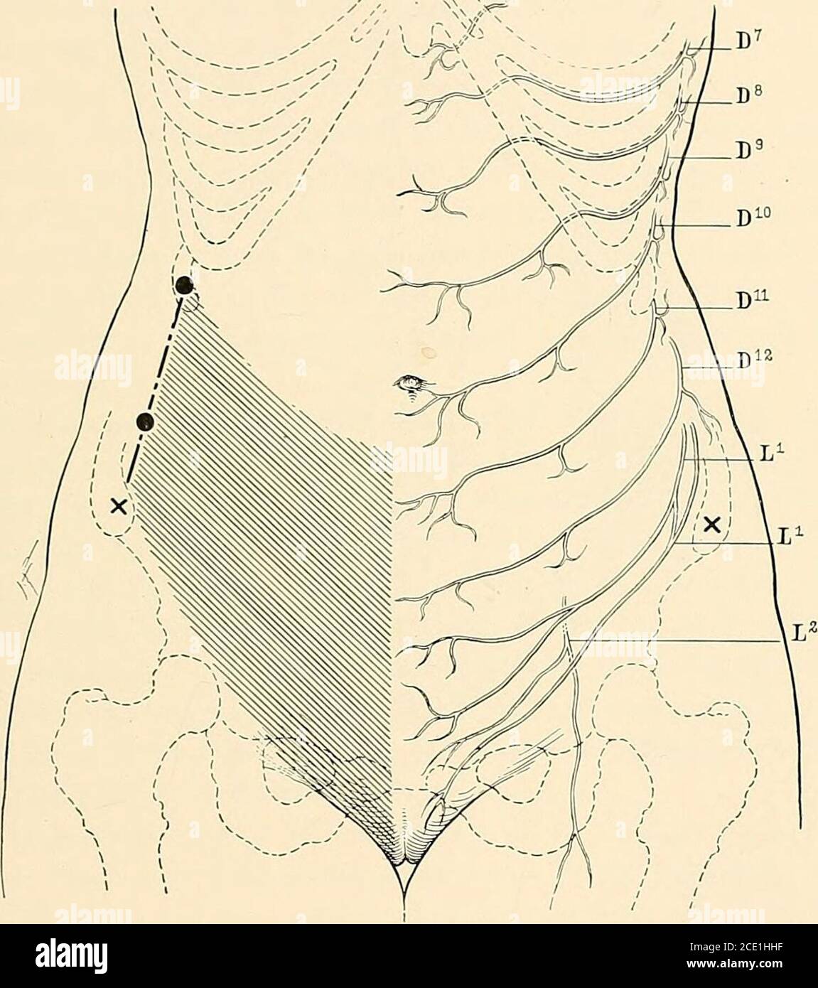 Rocky Davis Incision