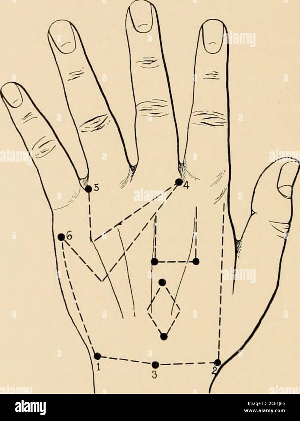 . Regional anesthesia : its technic and clinical application . Fig. 253 ...