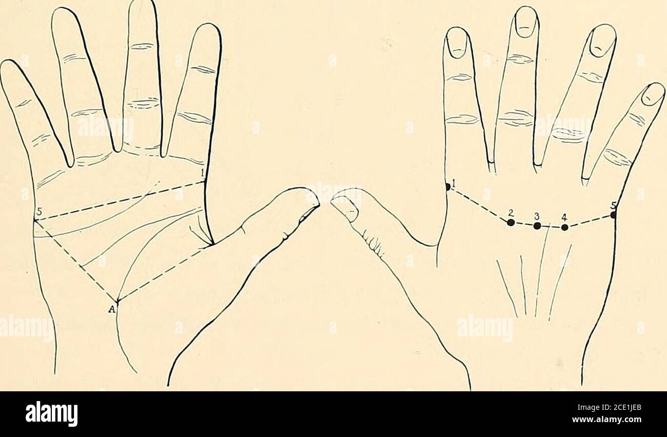 Hand wheals hi-res stock photography and images - Alamy