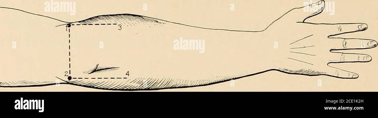 . Regional anesthesia : its technic and clinical application . Fig. 239 ...