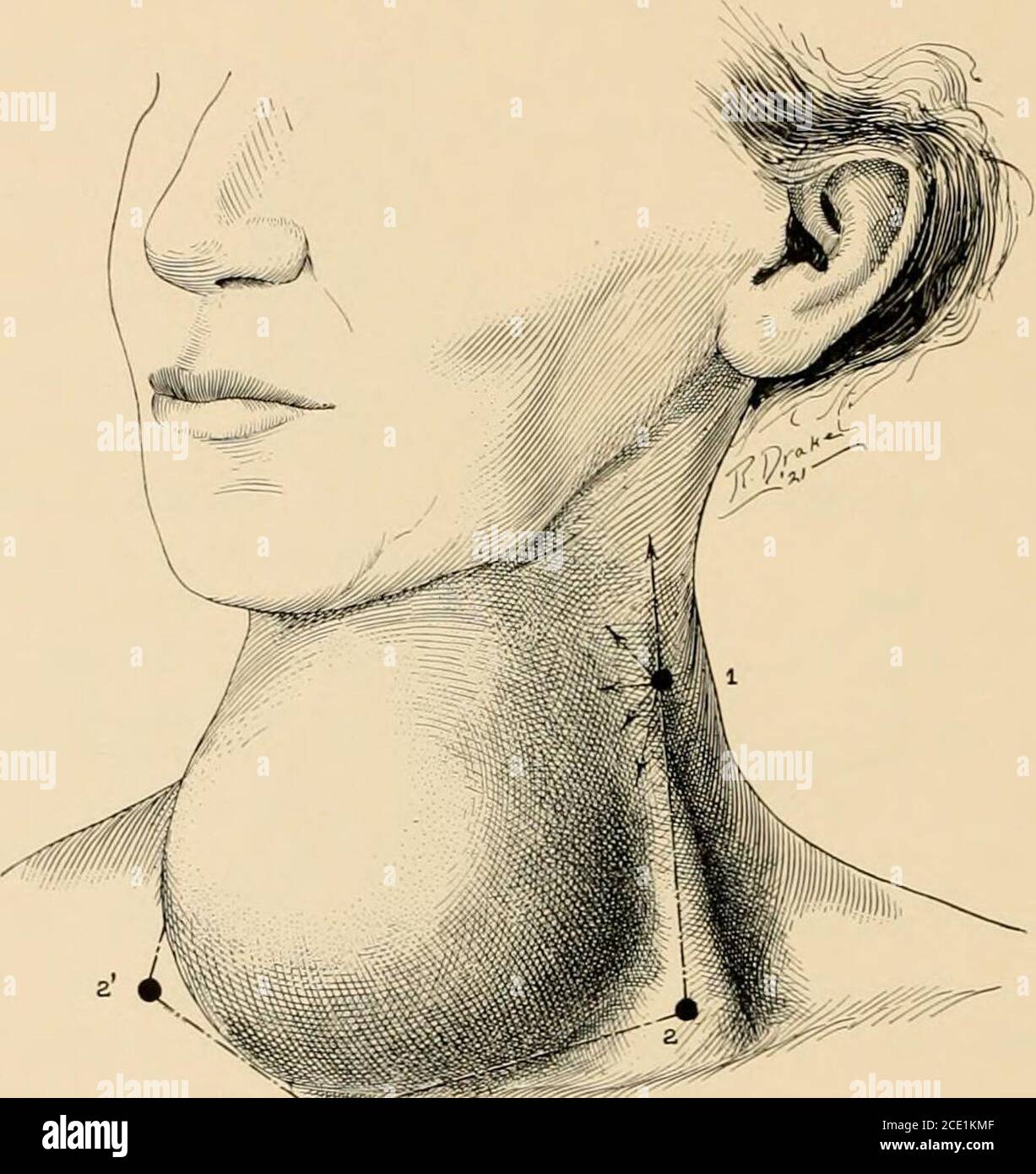 Simple goiter hi-res stock photography and images - Alamy