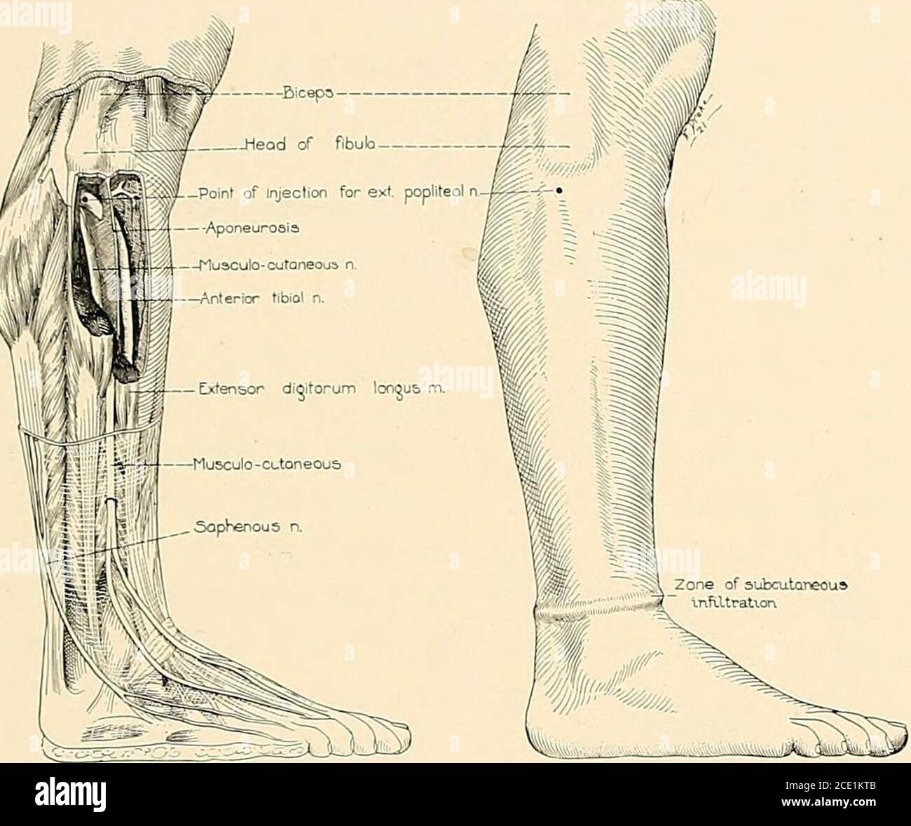 Popliteal Block