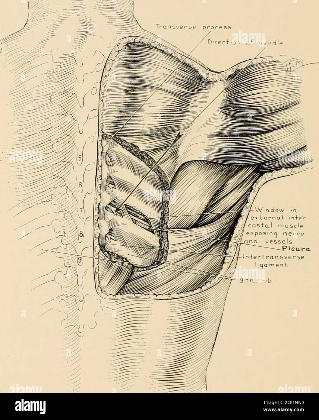 . Regional anesthesia : its technic and clinical application . Fig. 173 ...