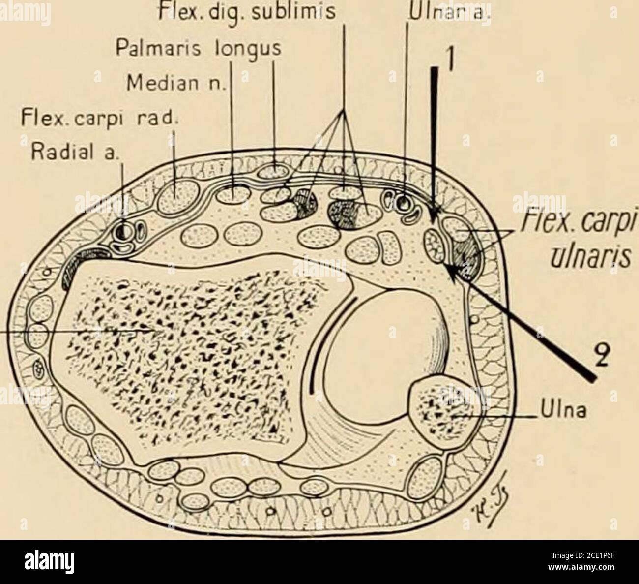 Ulnar nerve block hi-res stock photography and images - Alamy