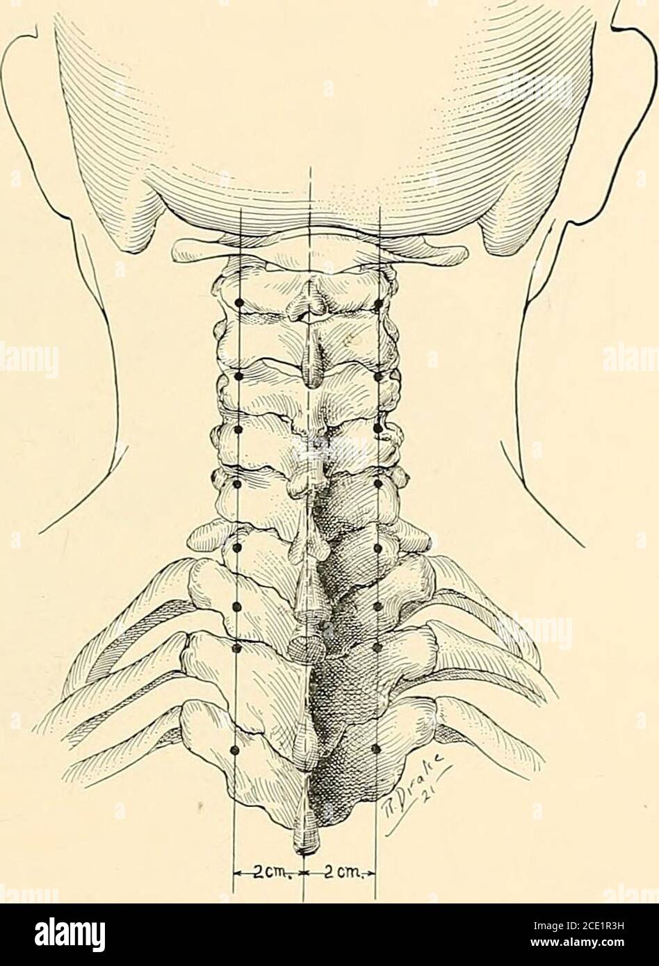 A Split In Spinous Process