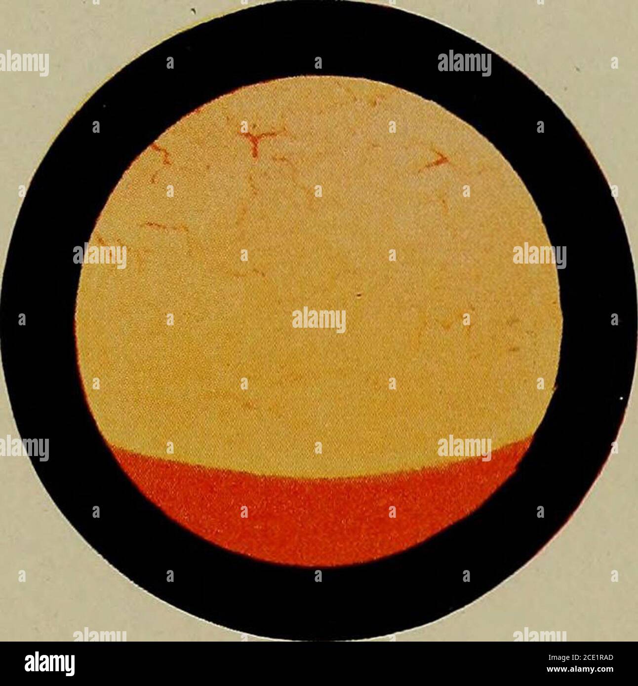 Mercury treatment for syphilis hi-res stock photography and images - Alamy