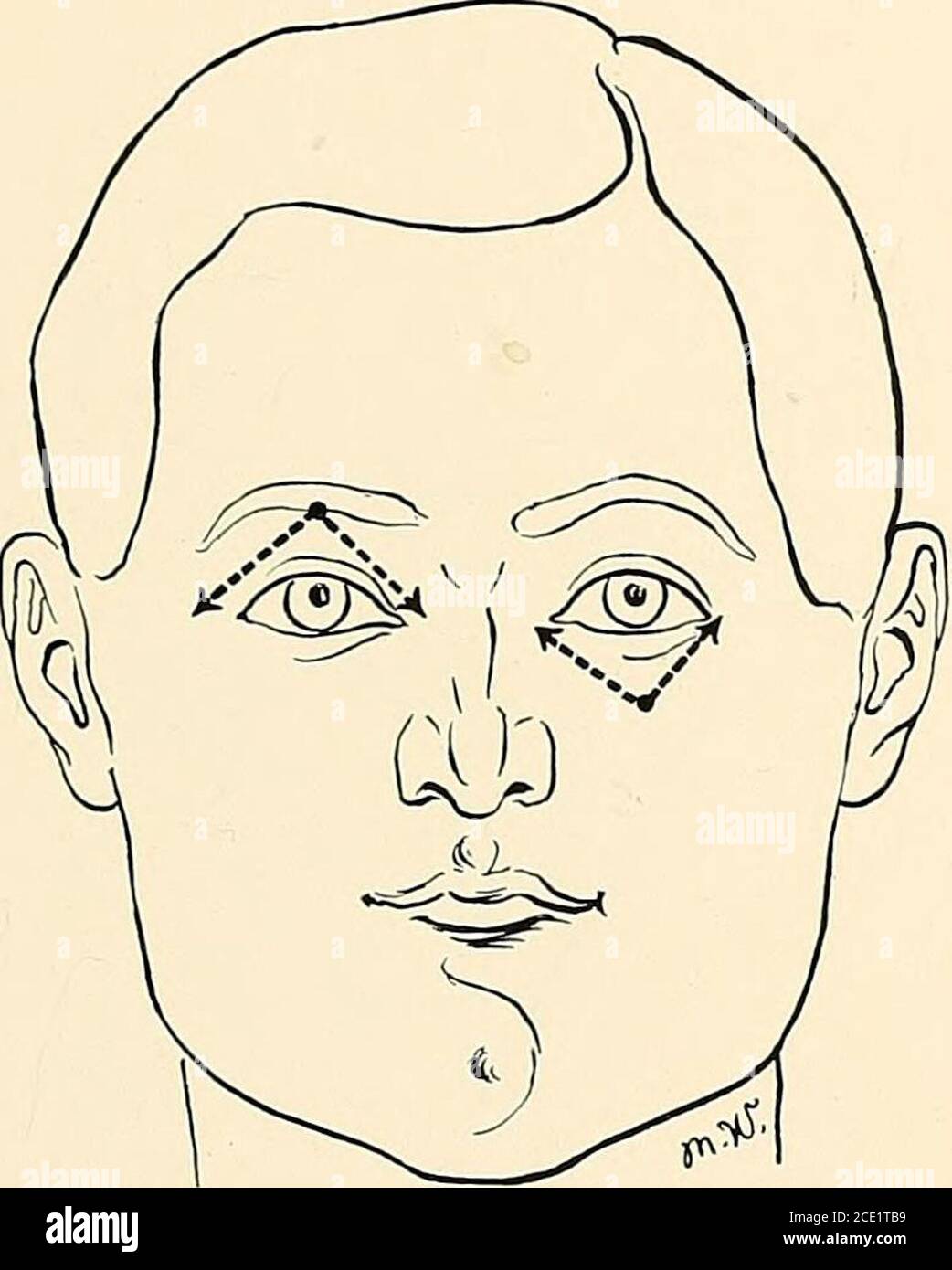 . Regional anesthesia : its technic and clinical application . xillary ...