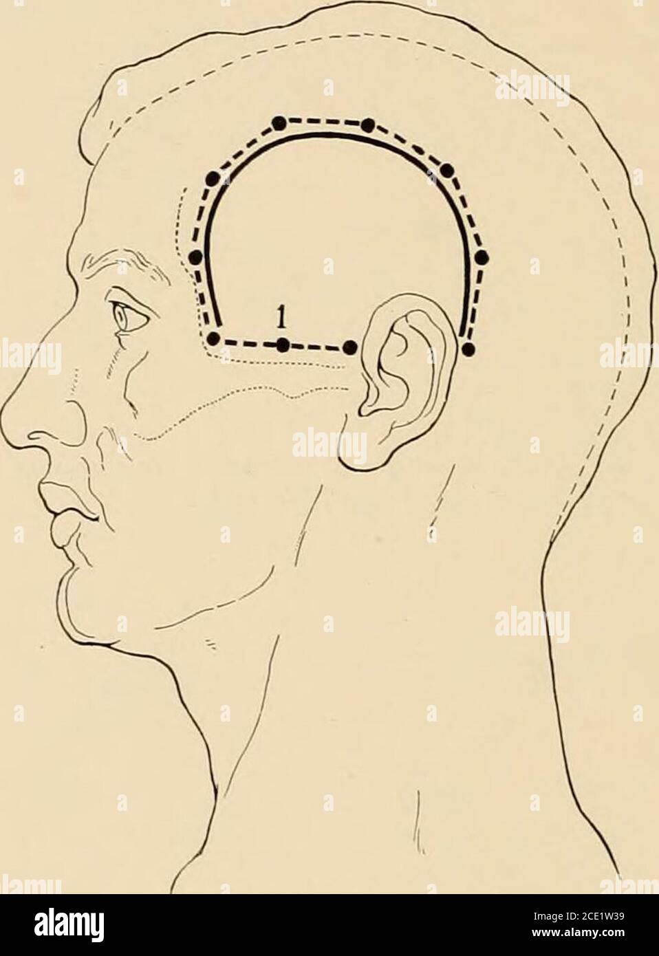 Epidural hematoma hi-res stock photography and images - Alamy