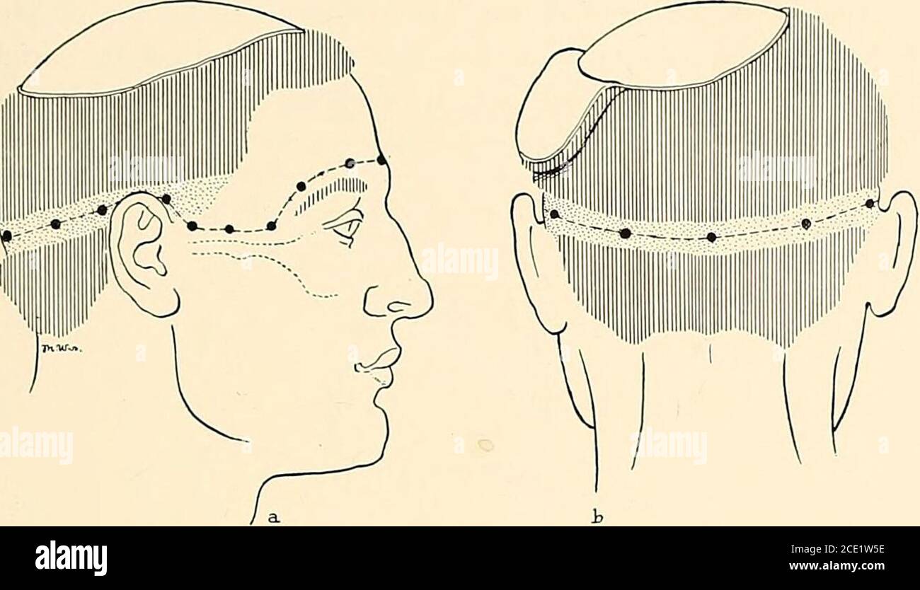 . Regional anesthesia : its technic and clinical application . Fig. 95 ...