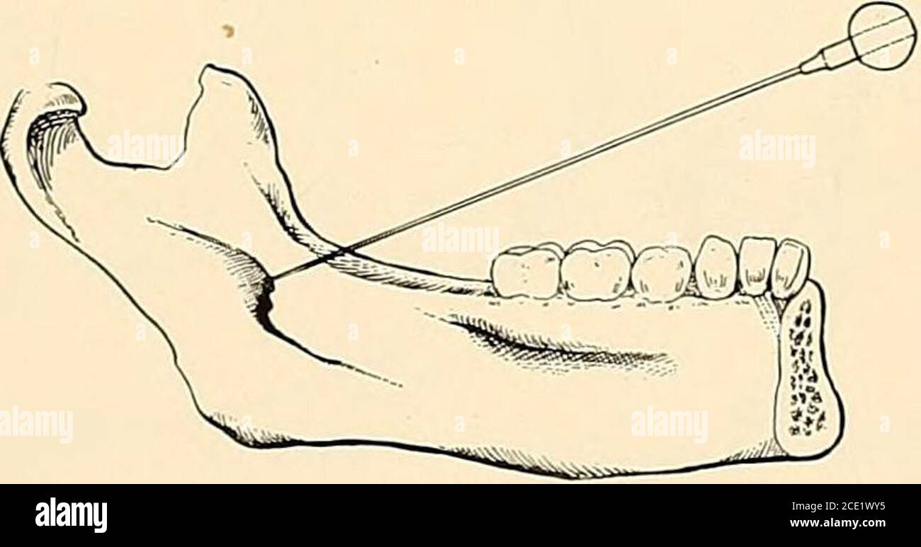 . Regional anesthesia : its technic and clinical application . Fig. 73 ...