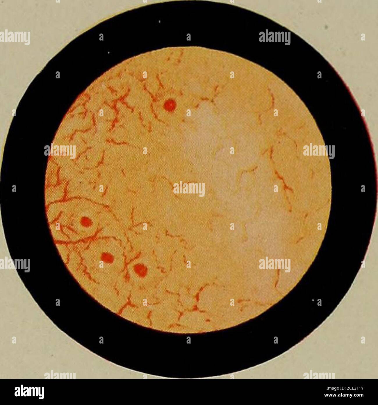 . Syphilis : a treatise on etiology, pathology, diagnosis, prognosis ...