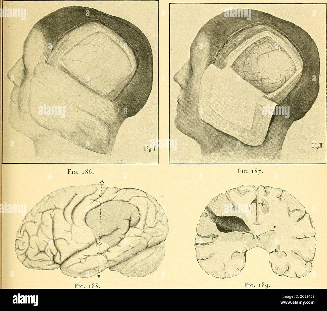 . Some points in the surgery of the brain and its membranes . sence of ...