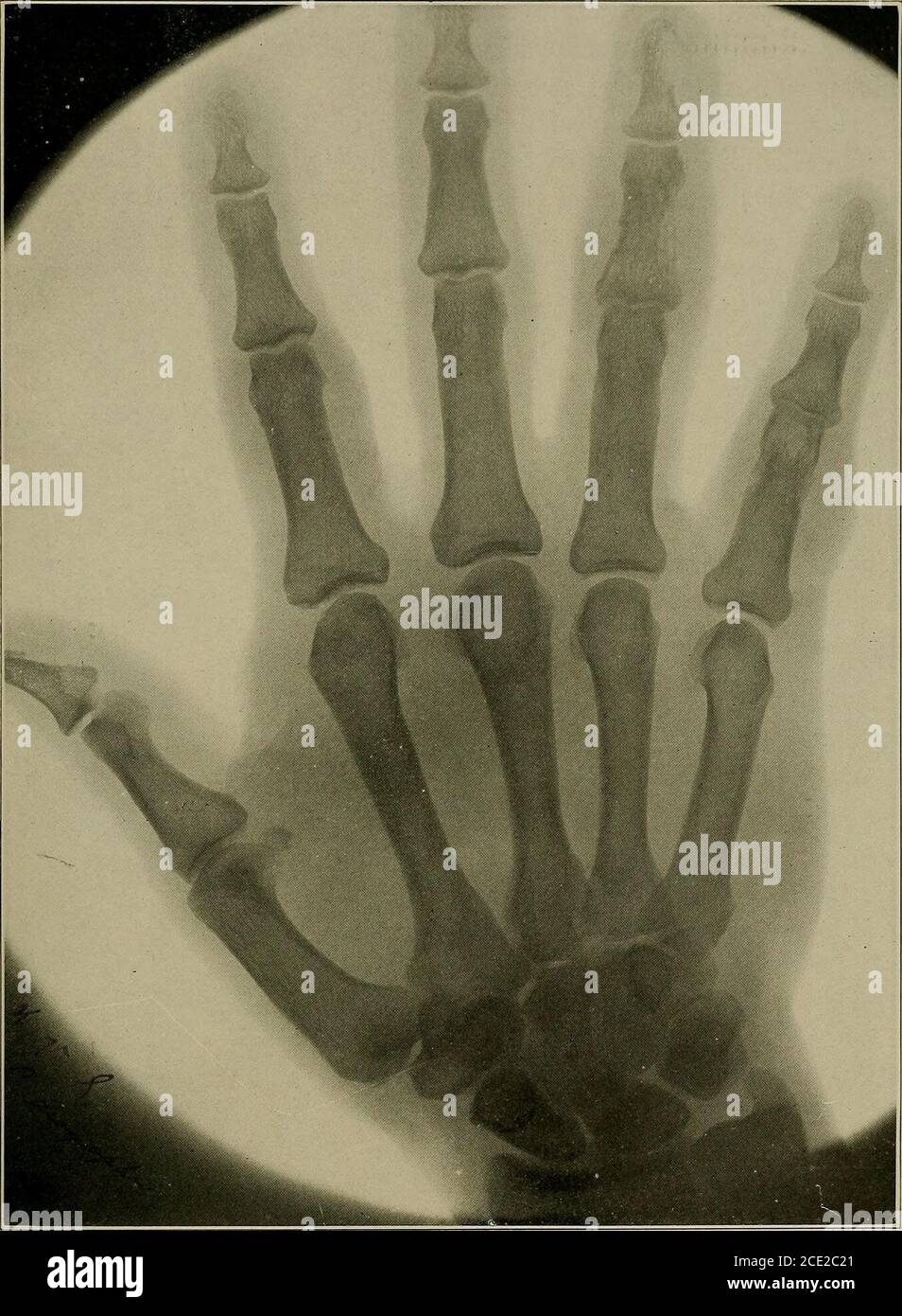 . Syphilis : a treatise on etiology, pathology, diagnosis, prognosis ...