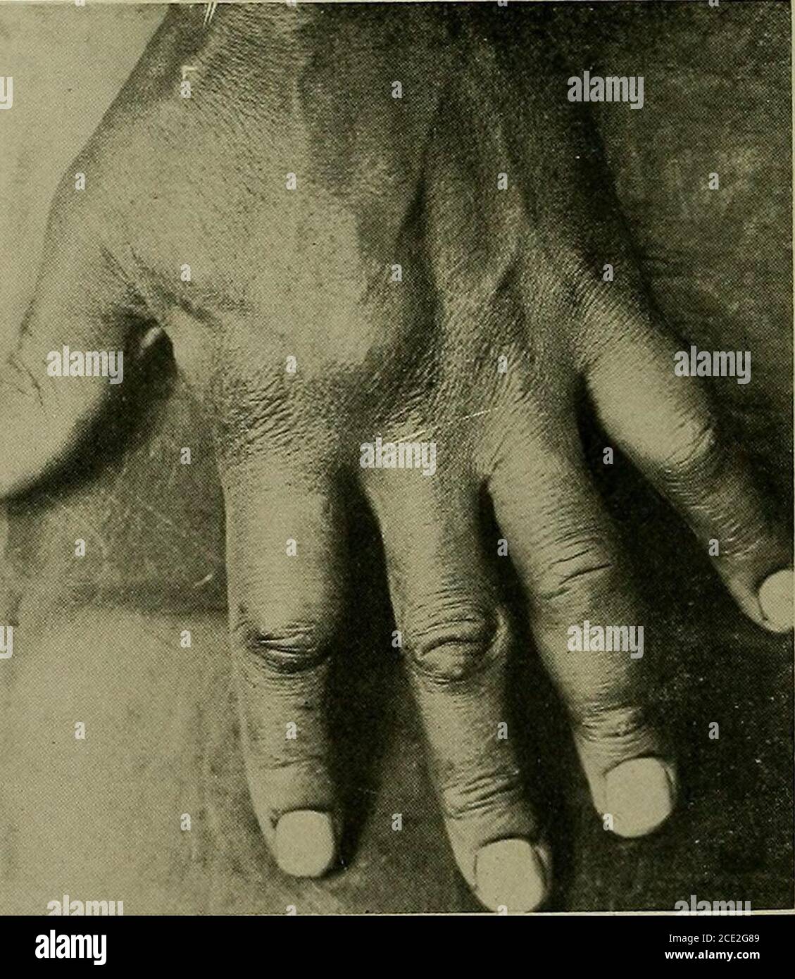 . Syphilis : a treatise on etiology, pathology, diagnosis, prognosis ...