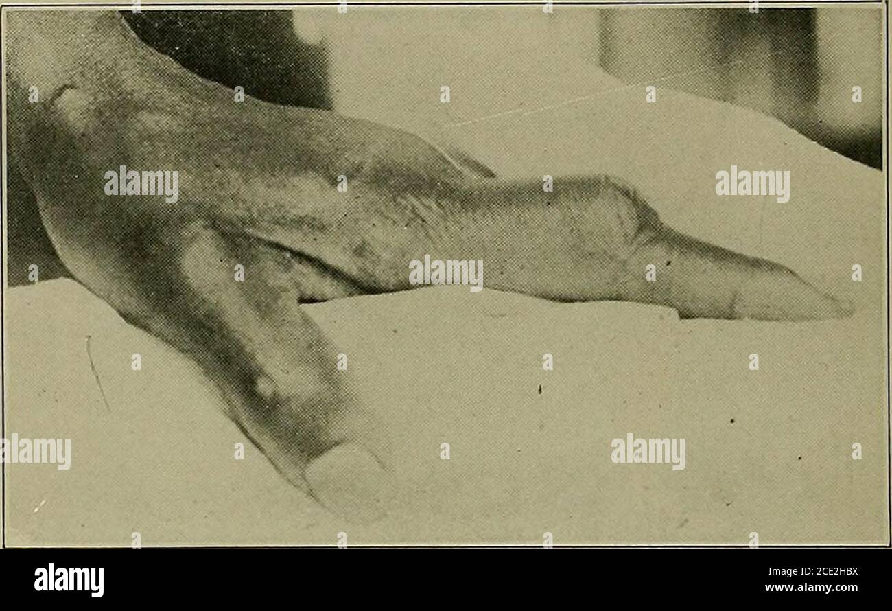 . Syphilis : a treatise on etiology, pathology, diagnosis, prognosis ...