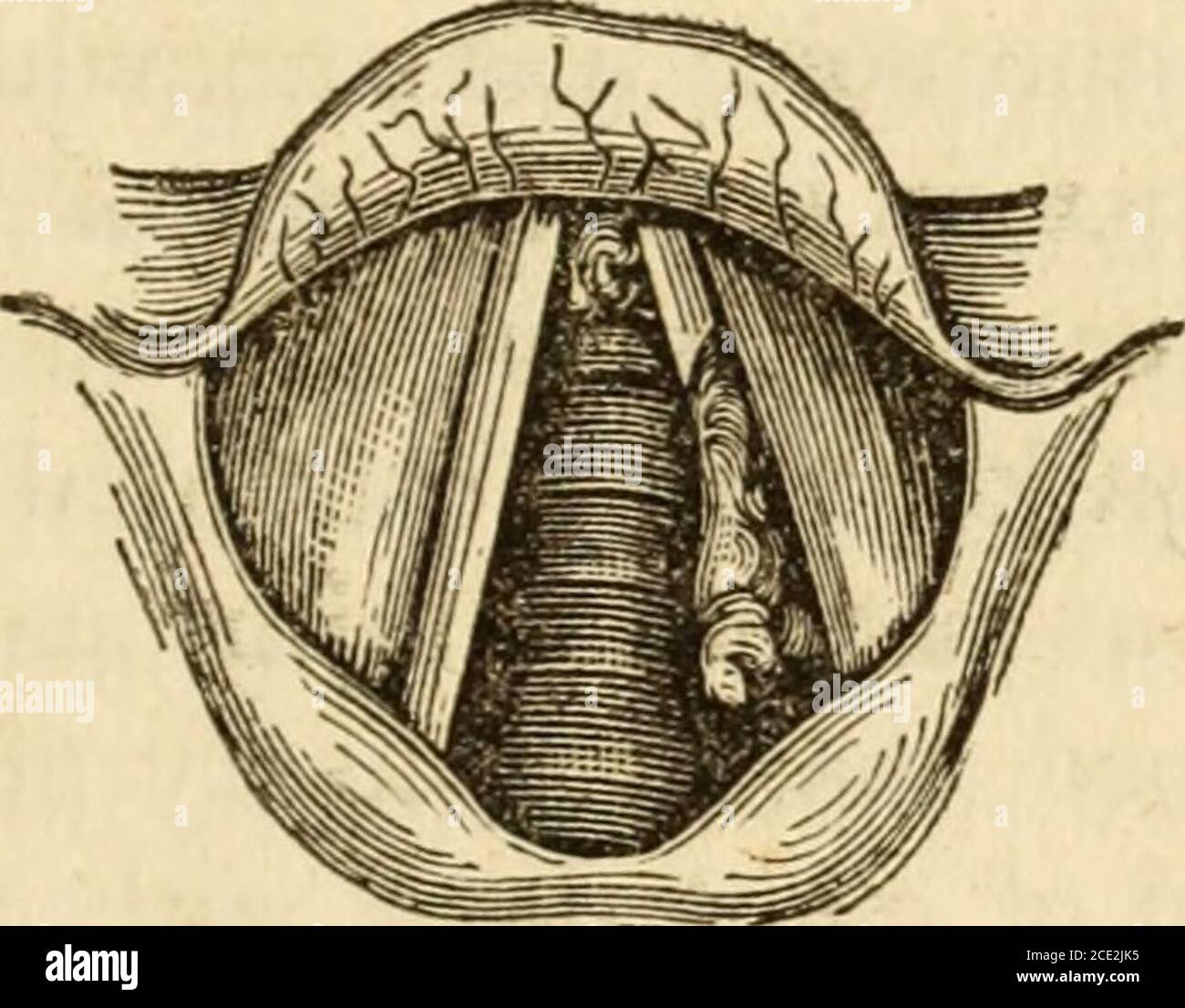 Polyp larynx hi-res stock photography and images - Alamy