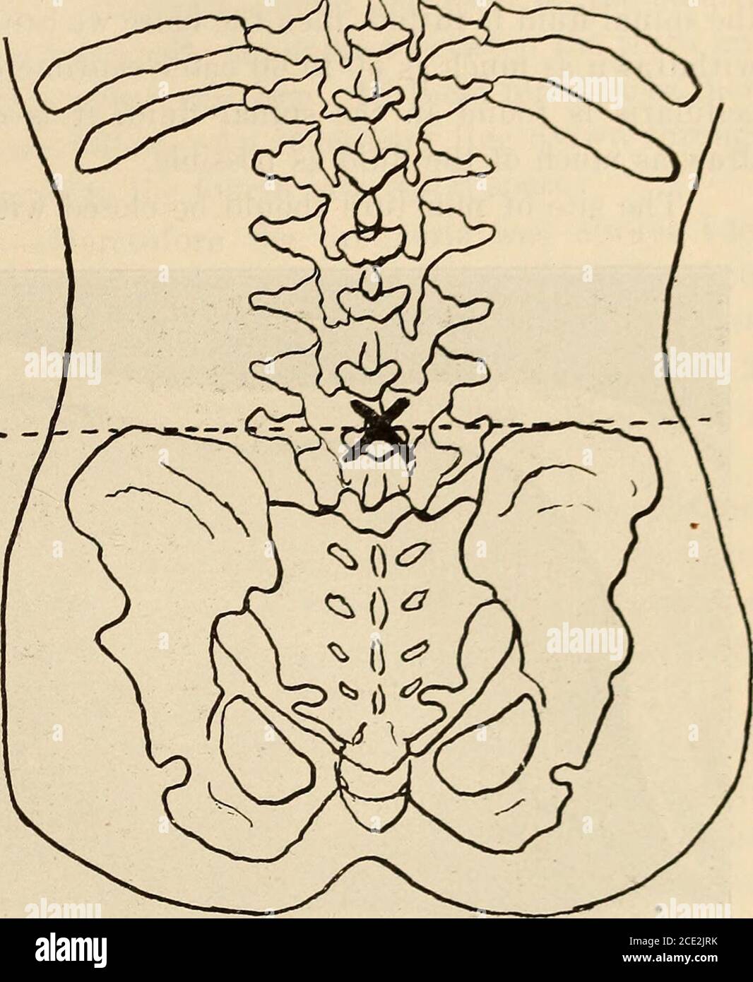 Third lumbar vertebrae hi-res stock photography and images - Alamy