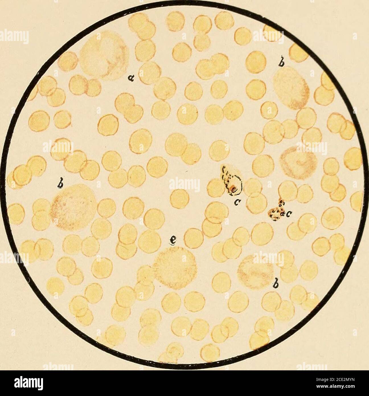 . Diseases of infancy and childhood . asm of the polynuclear ...