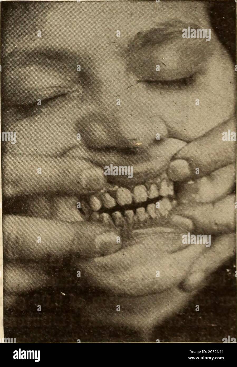 Absent tooth hi-res stock photography and images - Alamy