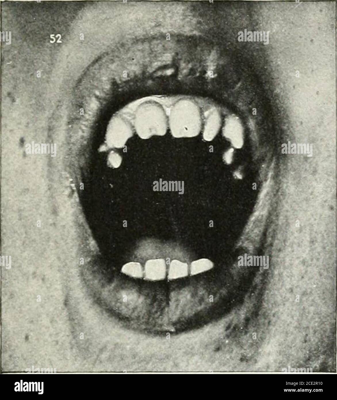 Dental cal hi-res stock photography and images - Alamy