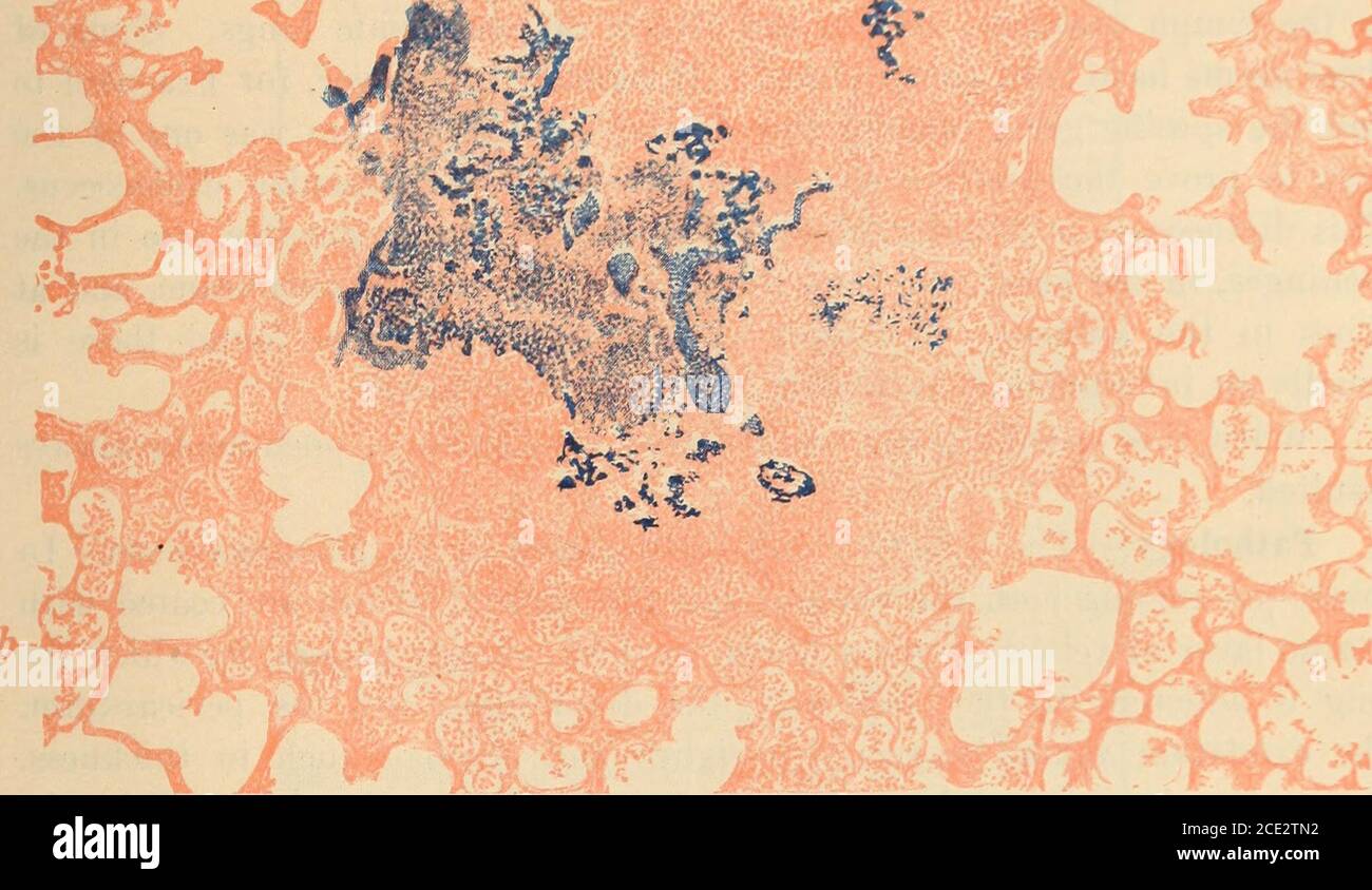 Metastatic diseases hi-res stock photography and images - Alamy