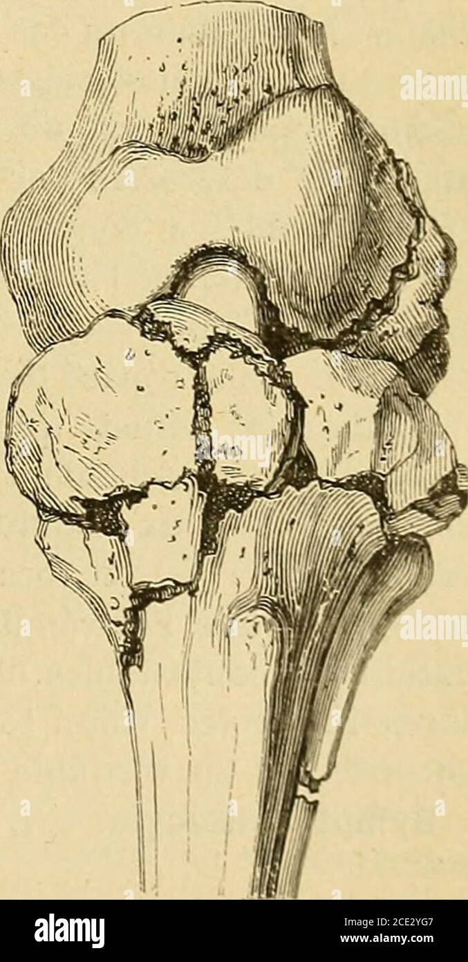 Tibial plateau hi-res stock photography and images - Alamy