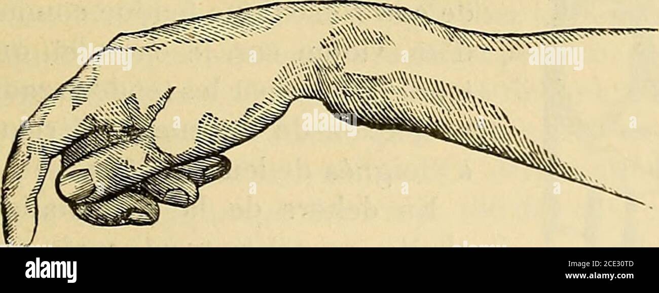 Fracture des doigts hi-res stock photography and images - Alamy