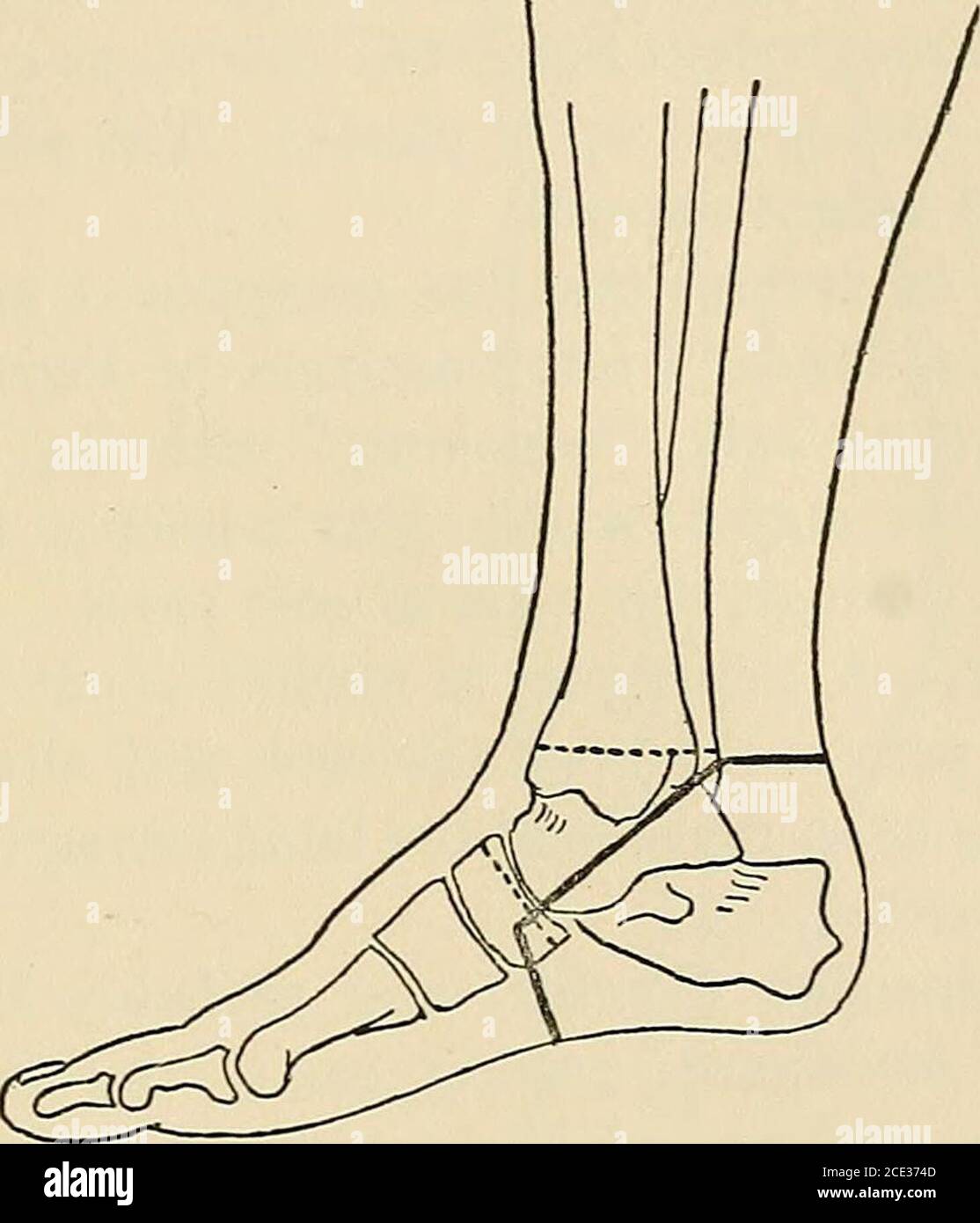 . Operative surgery, for students and practitioners . and this is to be ...