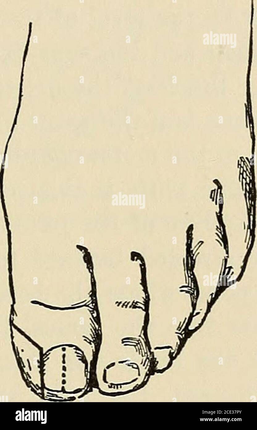 Littletoe hi-res stock photography and images - Alamy