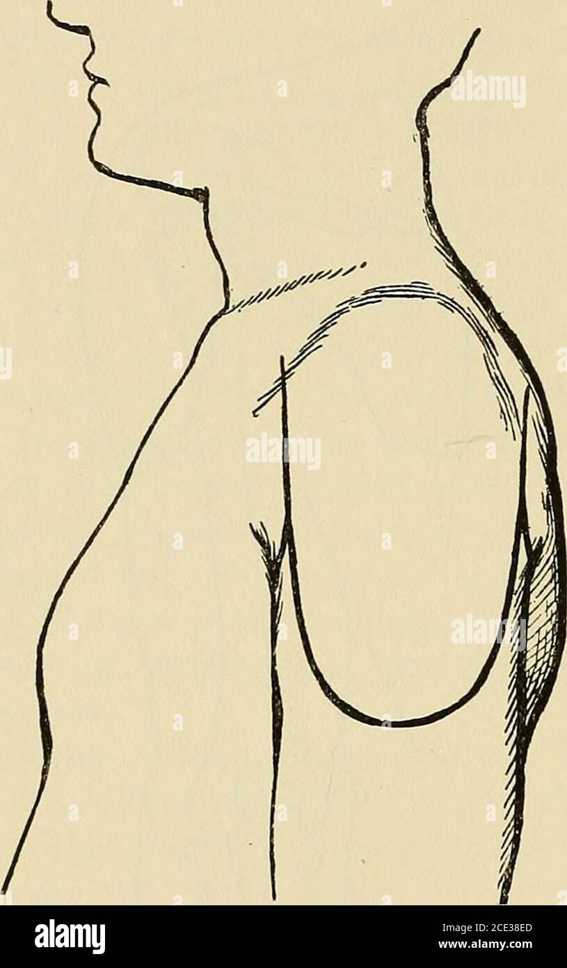 . Operative surgery, for students and practitioners . Fig. 232.—Right ...