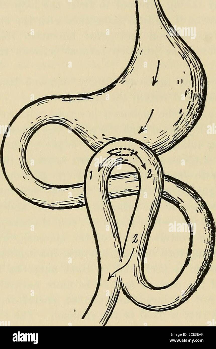 . Operative surgery, for students and practitioners . ly depend, in ...