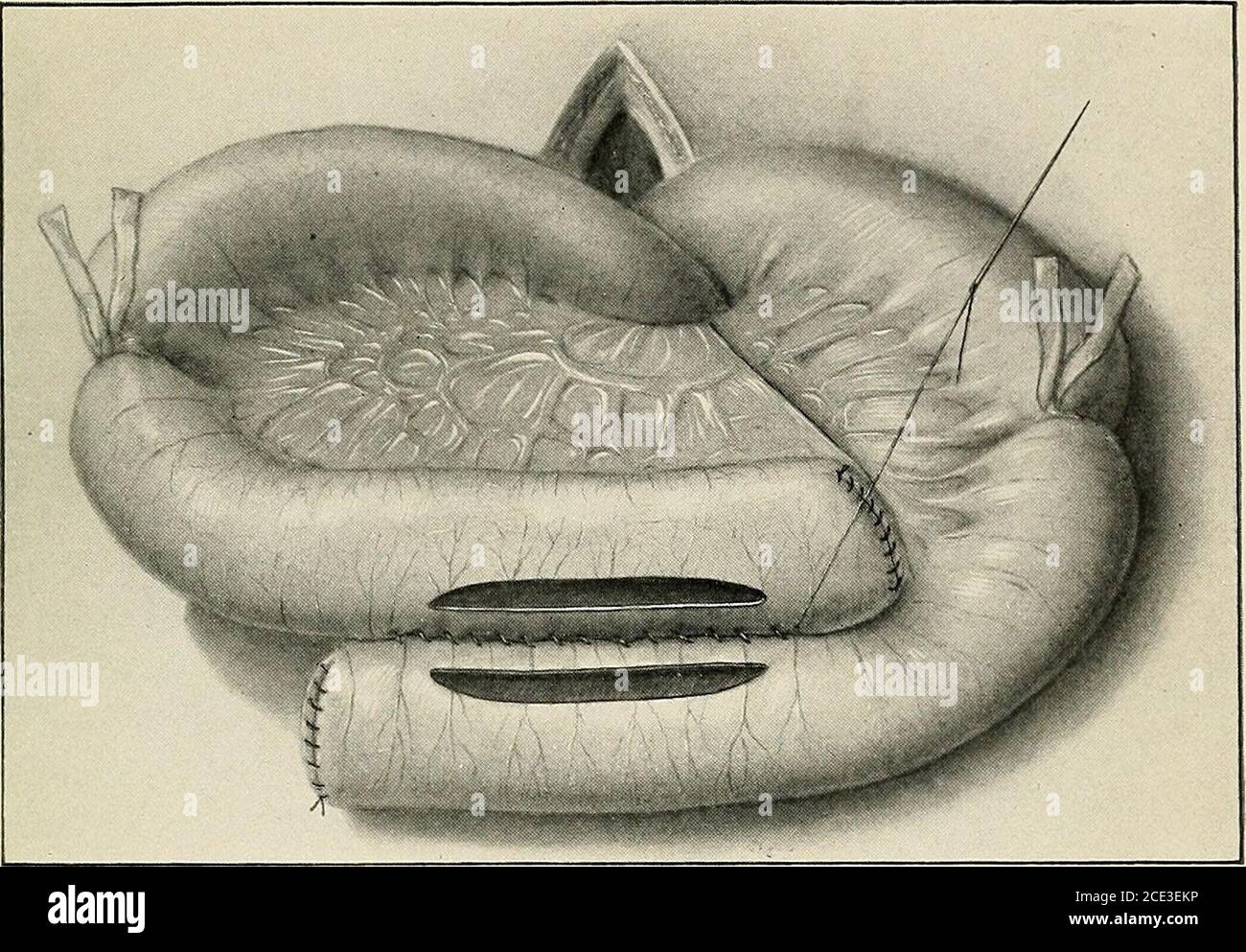 . Operative surgery, for students and practitioners . Lembert suturesof ...