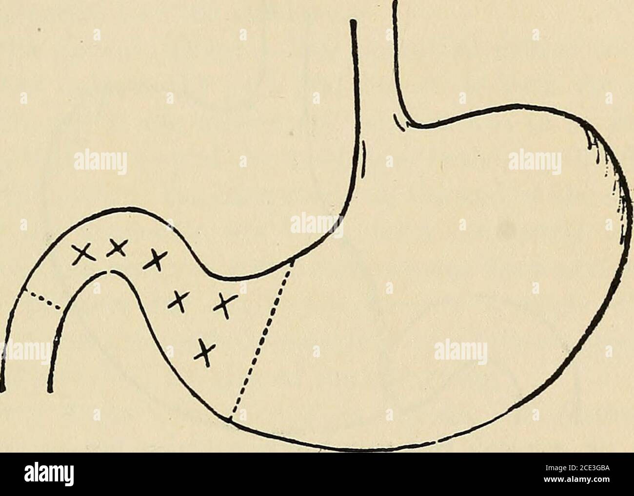 . Operative surgery, for students and practitioners . carried between ...