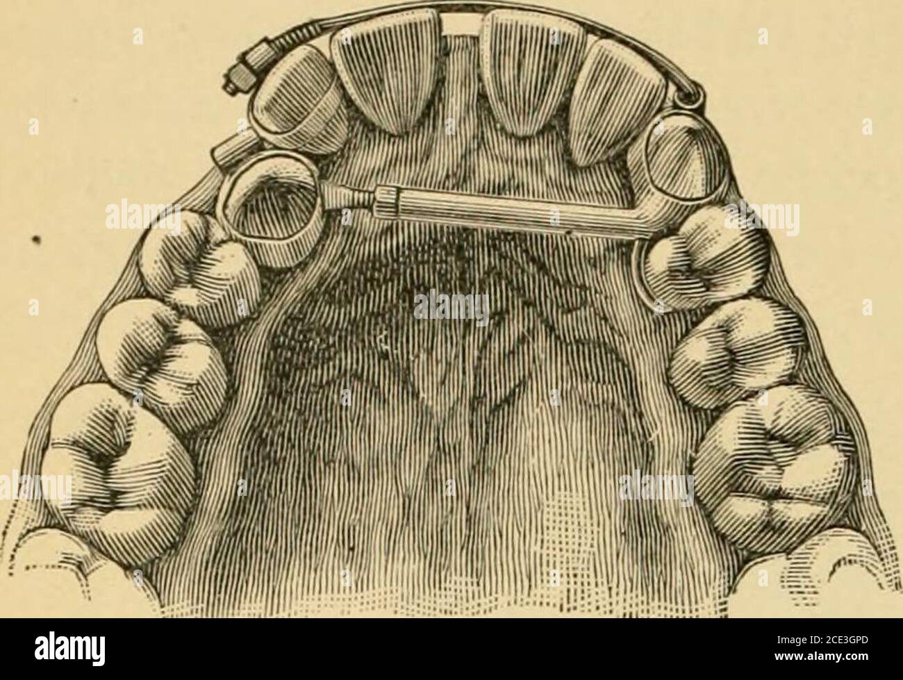 Labial Traction