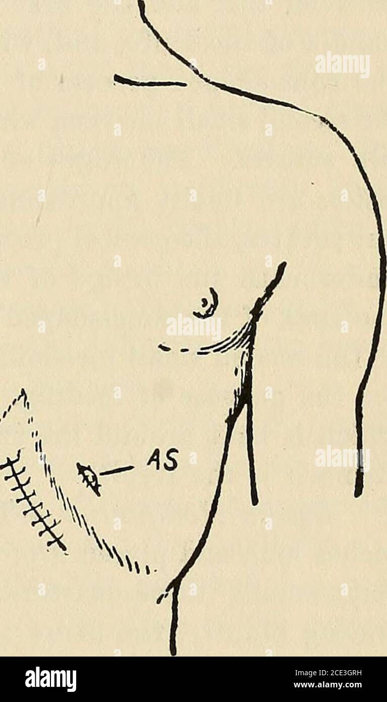 . Operative surgery, for students and practitioners . i A Fig. 106 ...