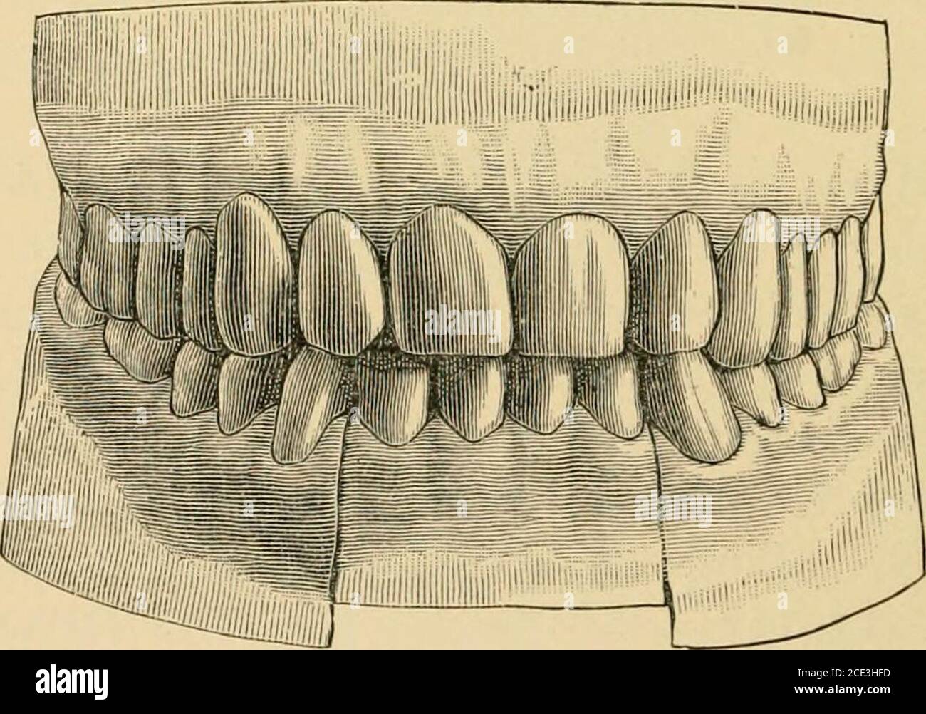 Bite splints hi-res stock photography and images - Alamy