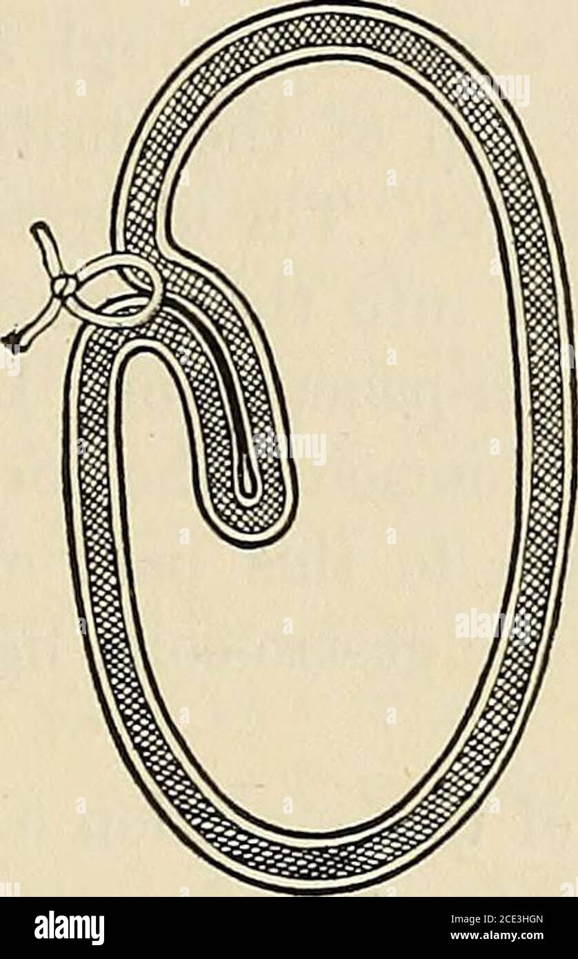 . Operative surgery, for students and practitioners . Fig. 96 ...