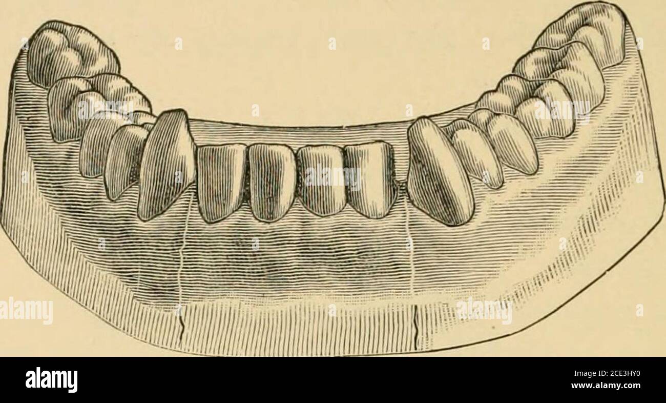 Preparing plaster casts hi-res stock photography and images - Alamy