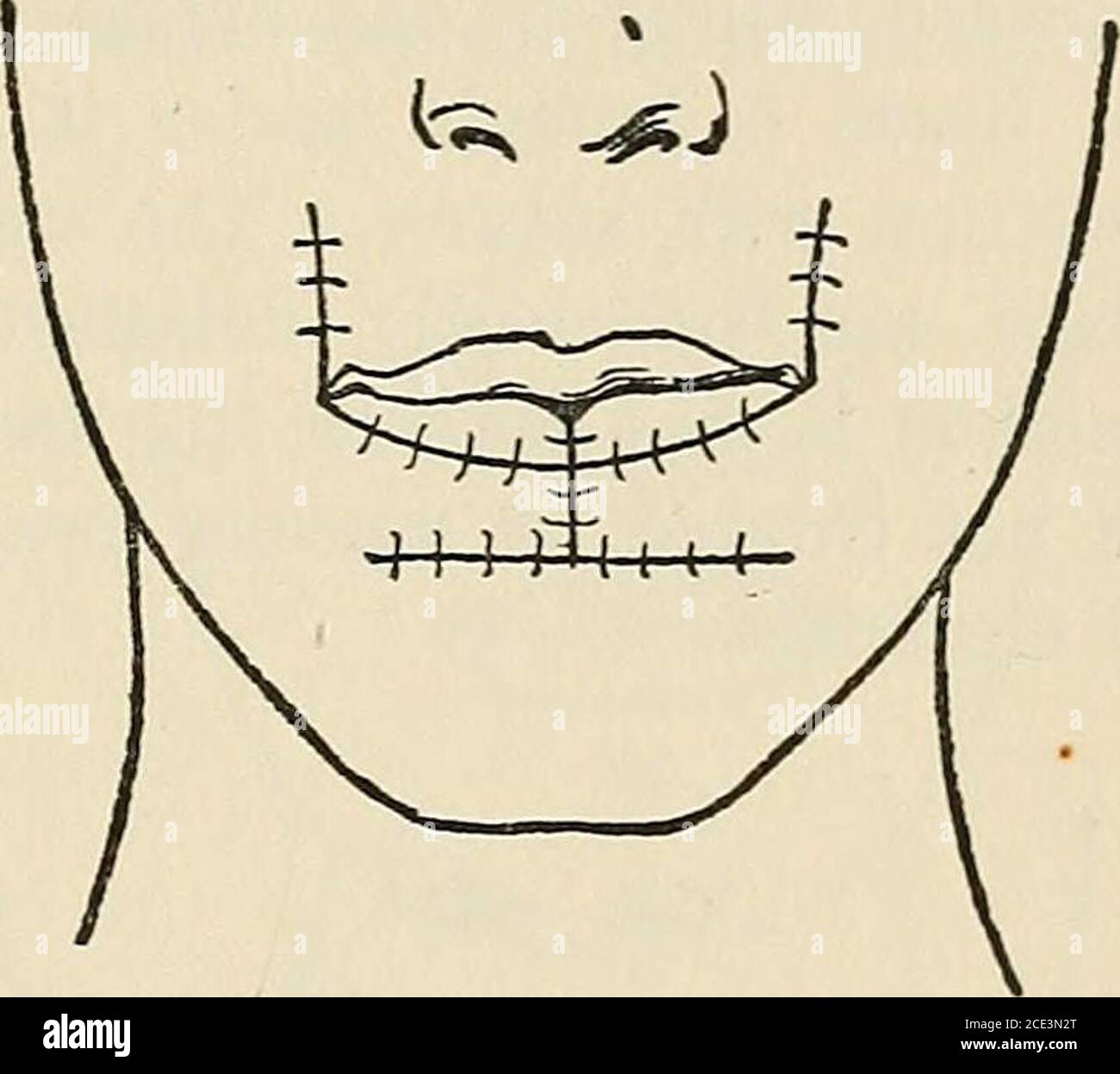 . Operative surgery, for students and practitioners . Fig. 66.—Bruns ...