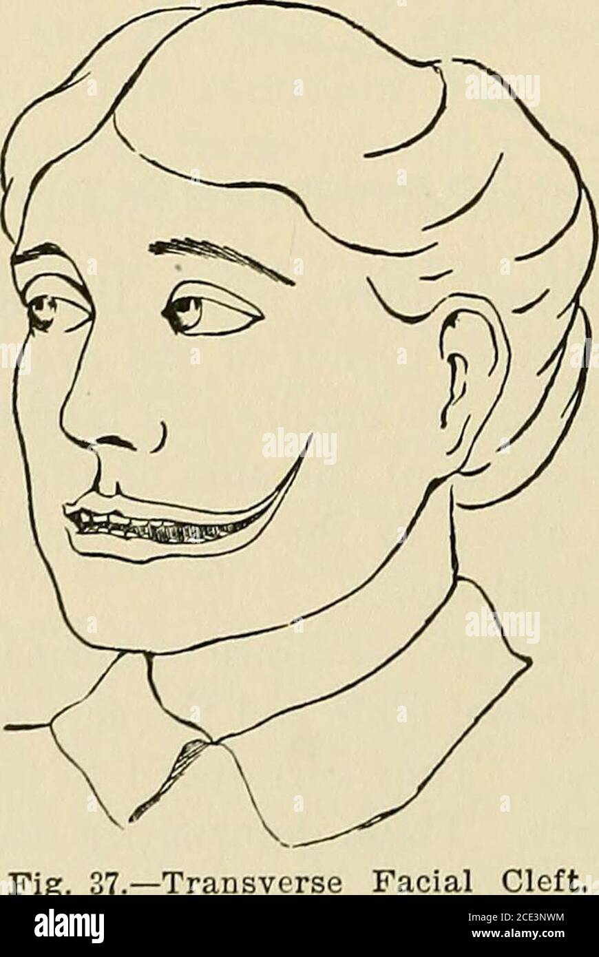 Transverse Facial Cleft