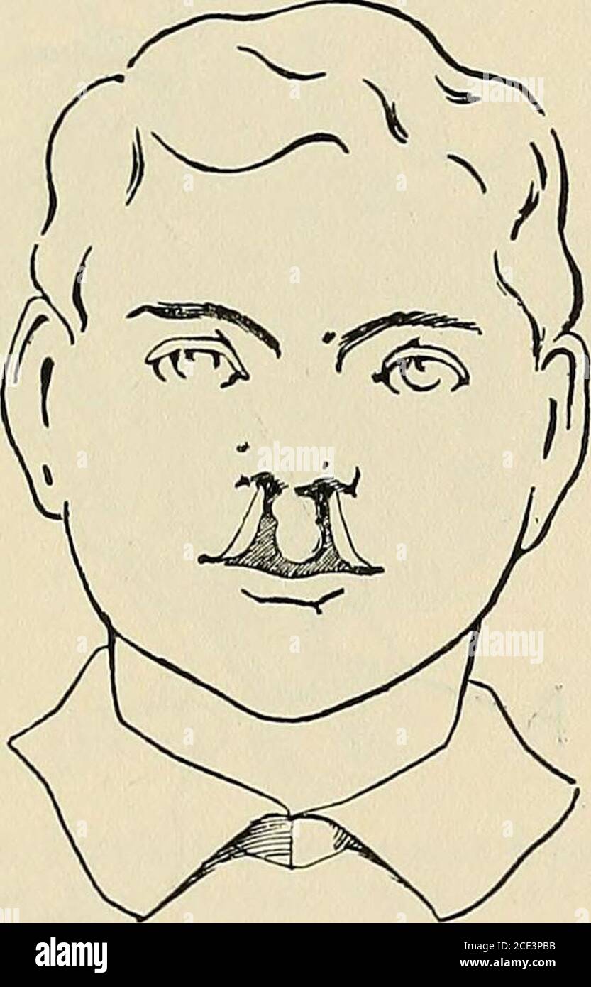 . Operative surgery, for students and practitioners . exaggerated form ...