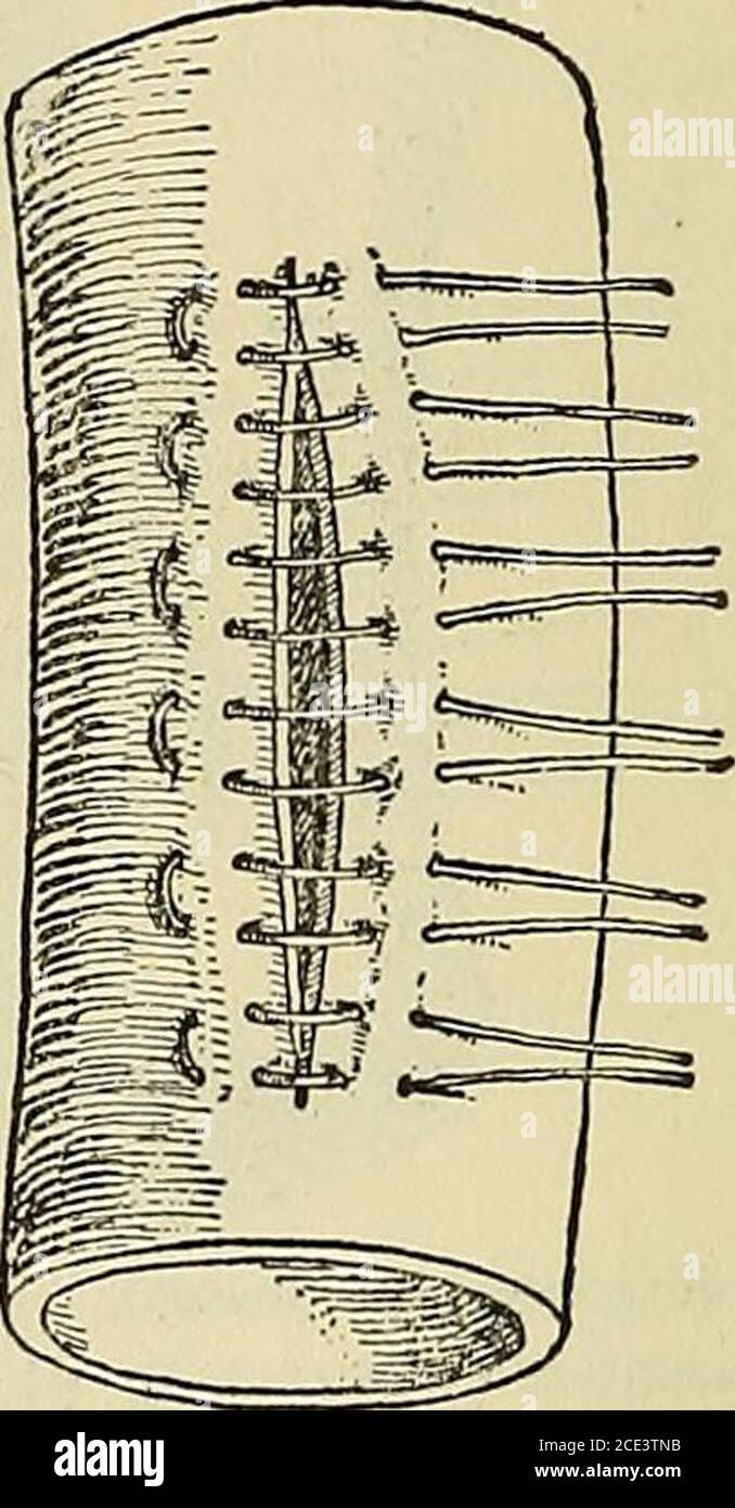 . Operative surgery, for students and practitioners . Fig. 12.—Halsteds ...
