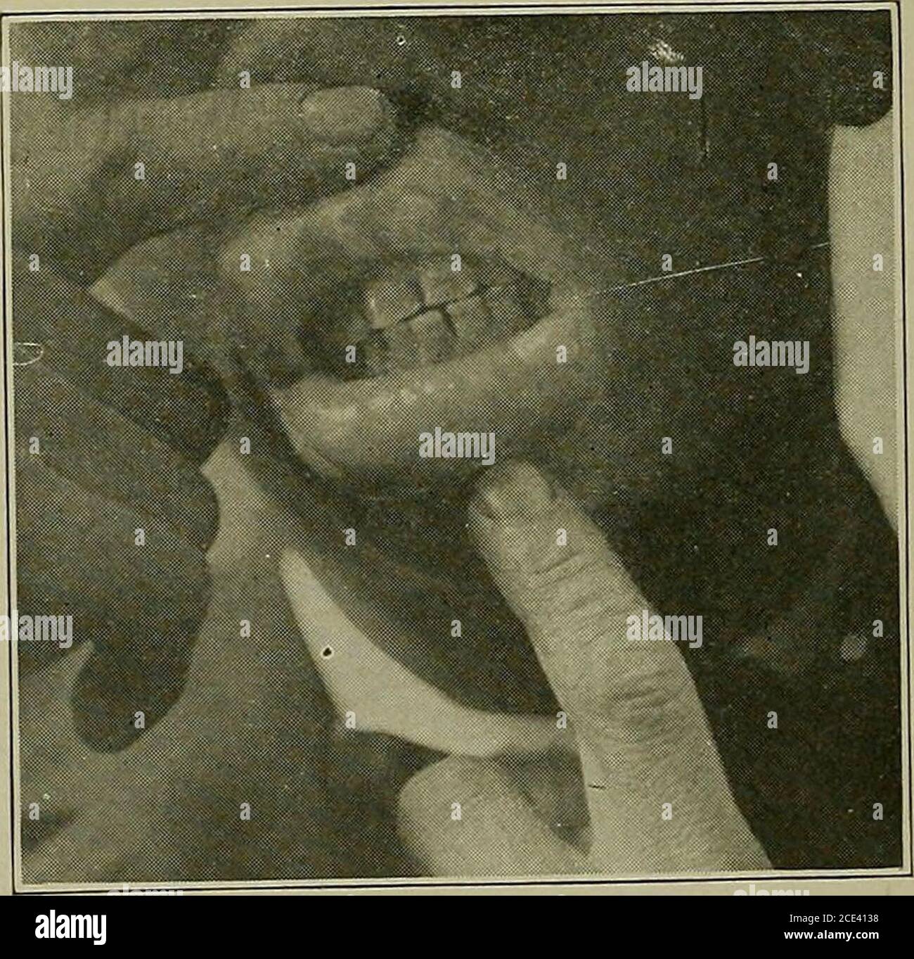 . Syphilis : a treatise on etiology, pathology, diagnosis, prognosis ...