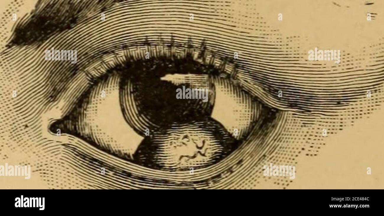 Corneal dermoid hi-res stock photography and images - Alamy