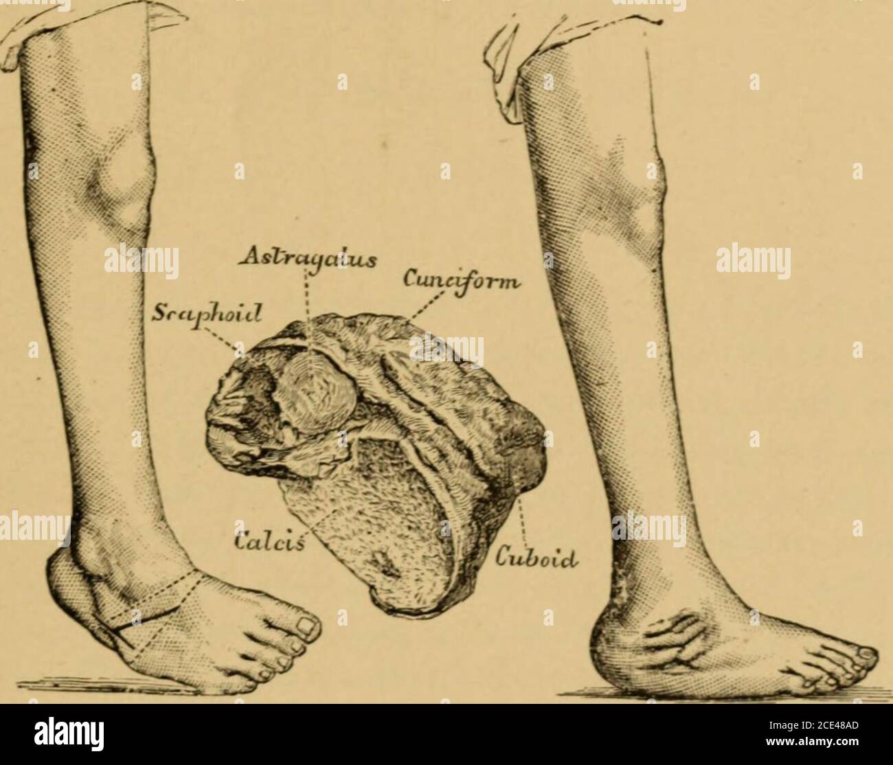 Talipes valgus hi-res stock photography and images - Alamy